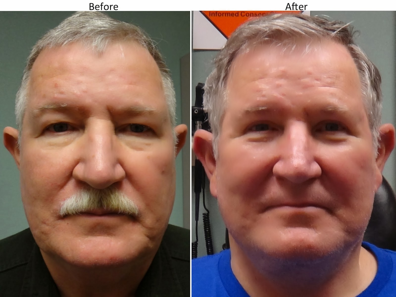 Facial Plastic Surgery: Male facelift, Upper and lower blepharoplasty ...