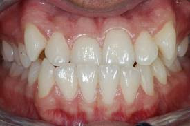 FAMILY CARE DENTAL: YOUR BITE: WHAT’S THE BIG DEAL?