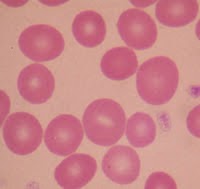 FICHERO DE HEMATOLOGÍA: ANORMALIDADES ERITROCITARIAS. Anormalidades en ...