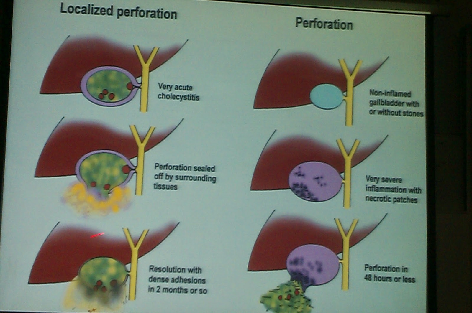 Lecture Slides; Surgery: Gallstones & Cholecystitis