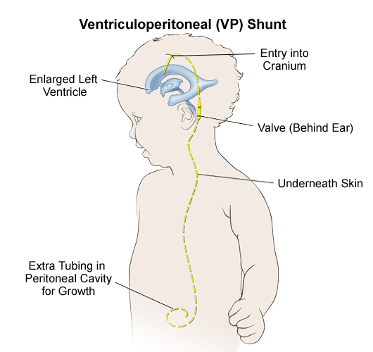 J Suresh Kumar: Hydrocephalus in infants - VP Shunting - Dr B ...