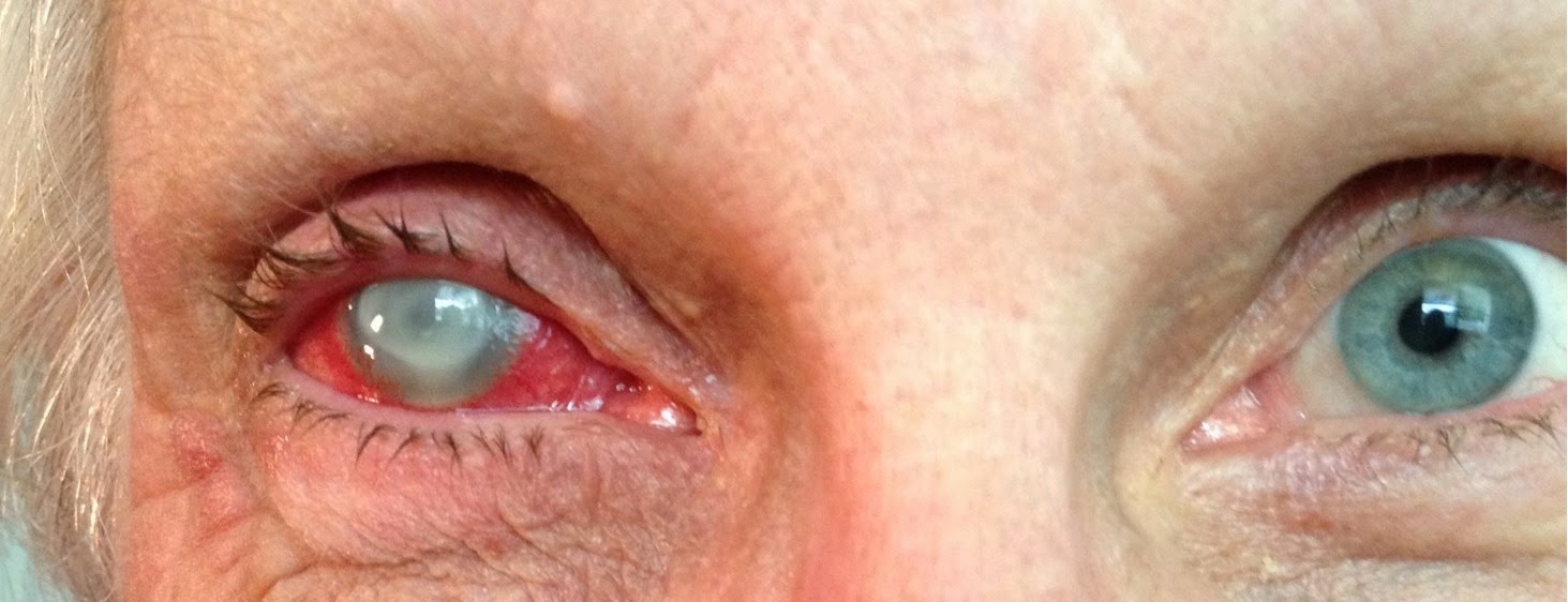 I Started Out As A Child: Acanthamoeba and Other Things I Knew Nothing ...