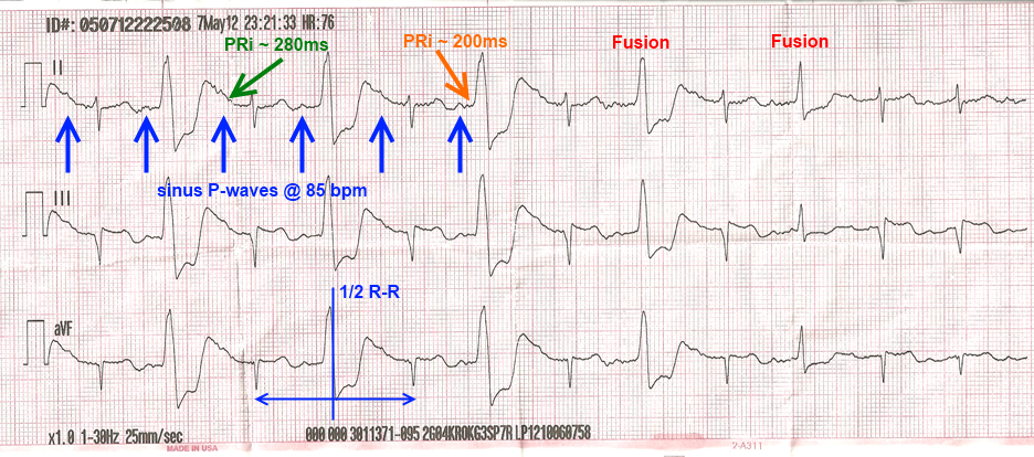 Bigeminy or paced rhythm? | EMTLIFE