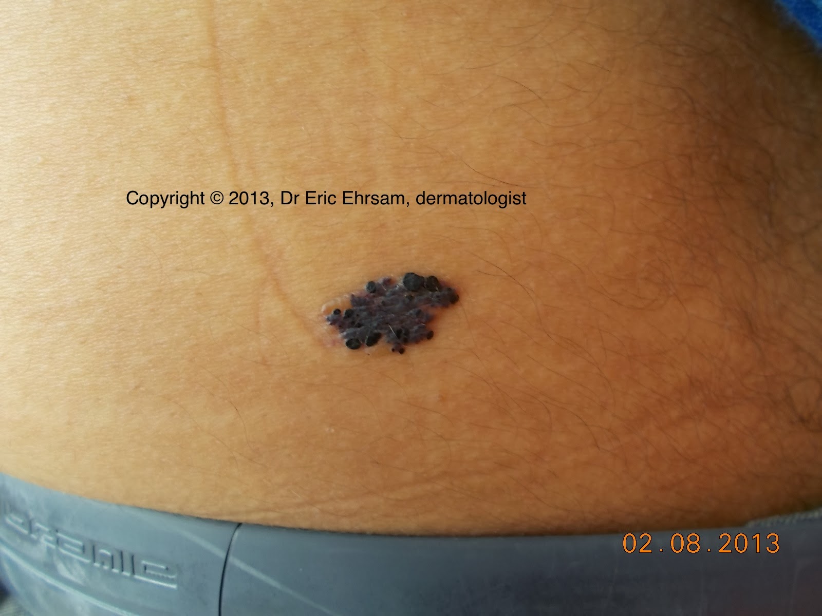 dermoscopy: Black grapes