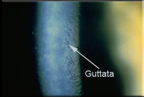 Médicos do Futuro: Distrofia de Fuchs