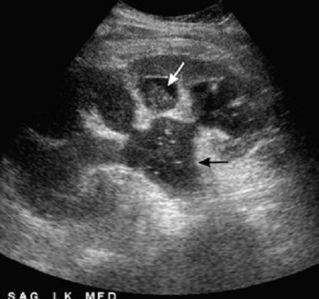 Renal Ultrasound Cases (Adrenal haemorrhage, Perinephric haematoma ...