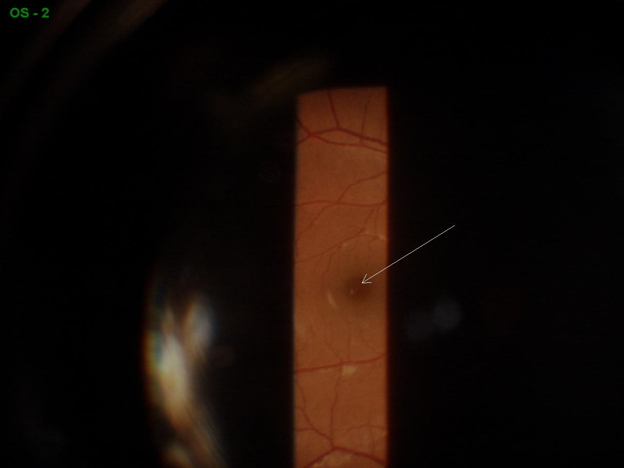 Sonoran Desert Eye Center Macular Pseudohole