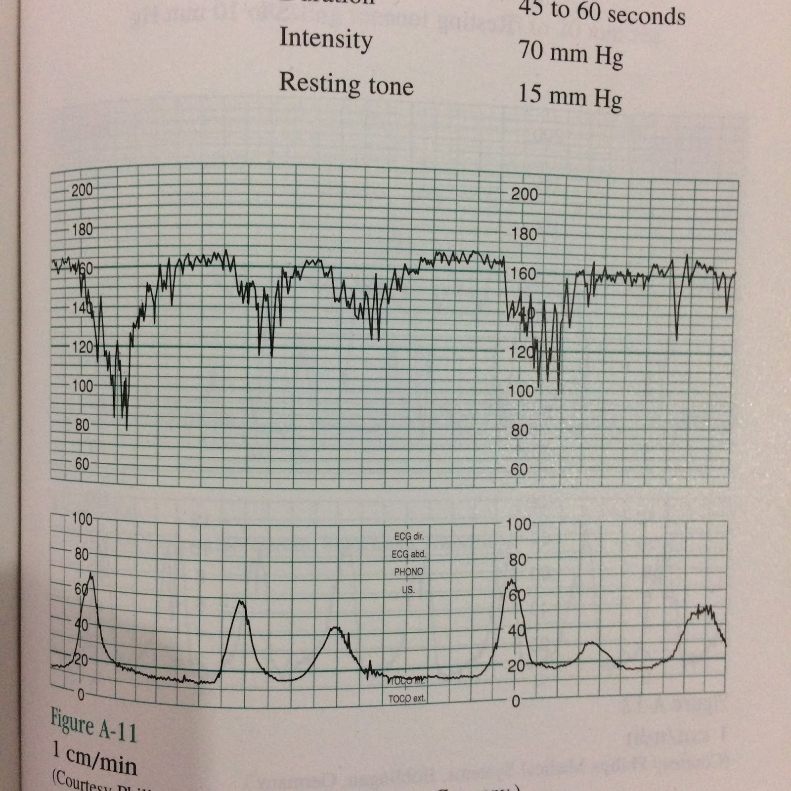 CTG ( CardioTocoGrafi) ~ info up date bidan