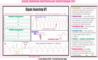 ECG Educator Blog : Is it VT?
