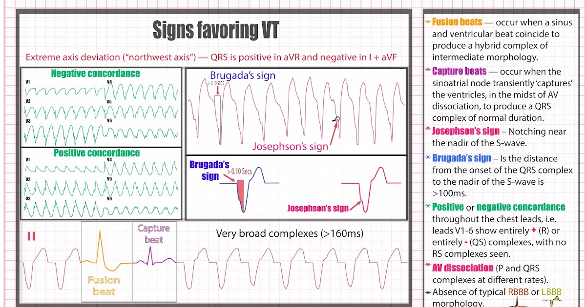 ECG Educator Blog : Is it VT?