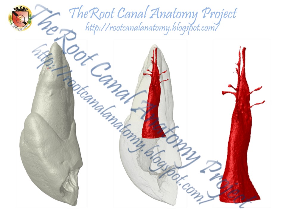 The Root Canal Anatomy Project: Two-Rooted Maxillary Central Incisor