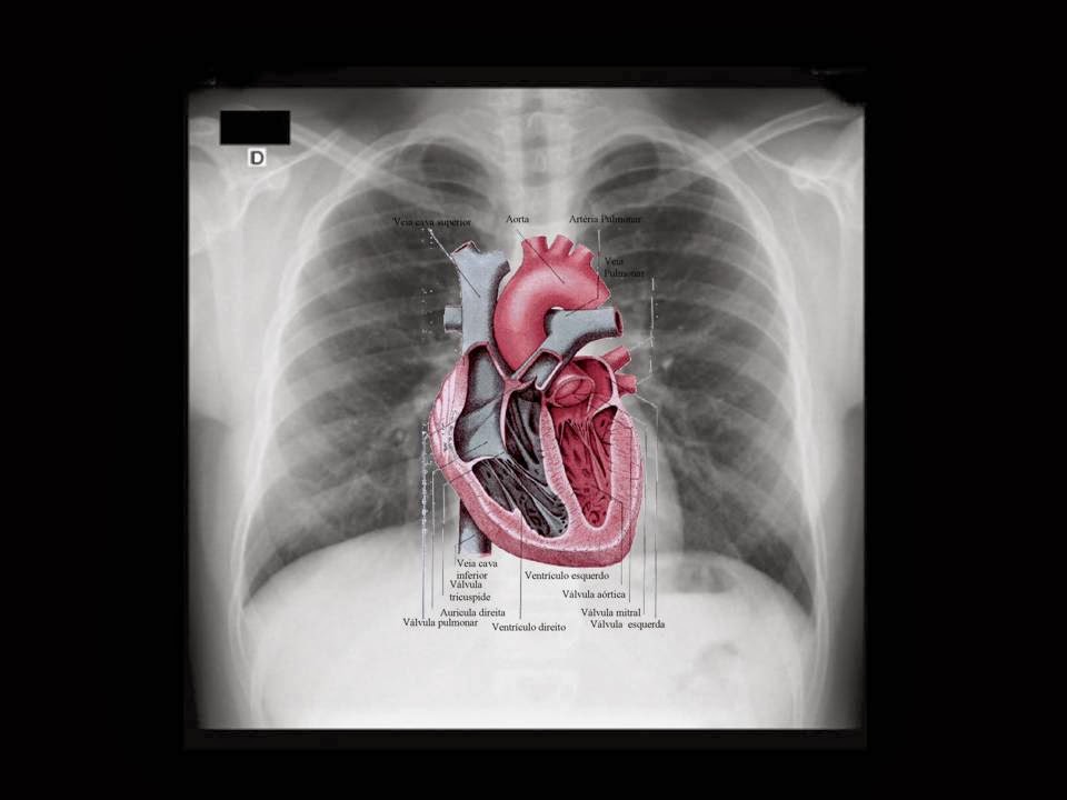 USS Diagnóstico por Imagem: Aula 8 - Radiologia do coração e vasos da base