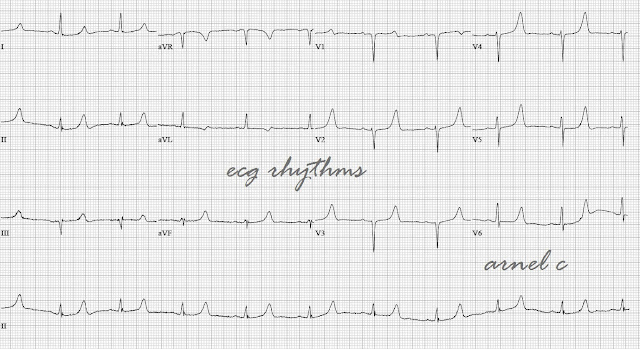 ECG Rhythms: Hyperkalemia and hypocalcemia