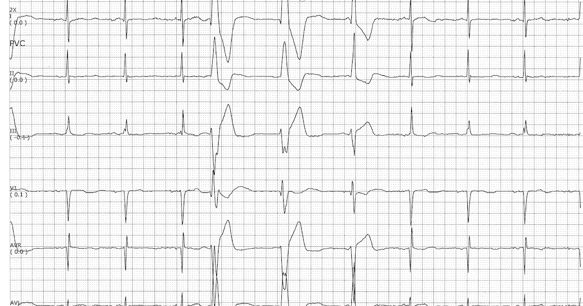 Float Nurse: Sinus Bradycardia with Ventricular Escape Beats