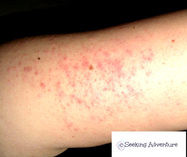 List 104+ Pictures Sun Rash Pictures On Arms Completed