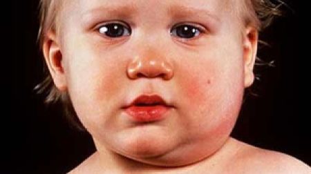 Fransisca said "Knowledge is Power": PAROTITIS (Gondongan)