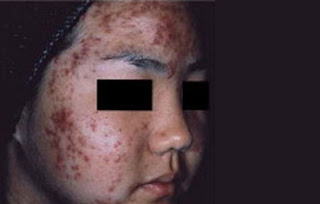 Head of the Class: Dermatology topic: Acne, Part 1