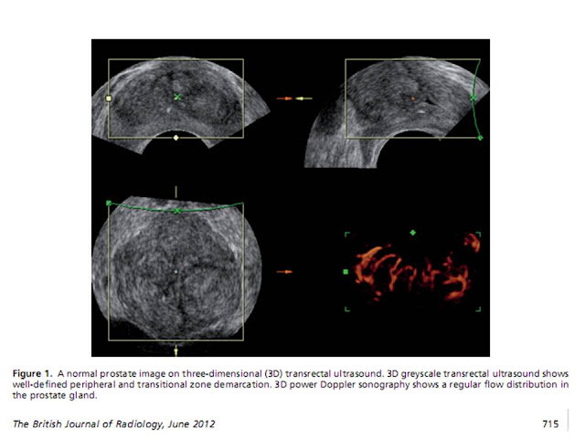 BÀI SOẠN VỀ SIÊU ÂM CHẨN ĐOÁN: 3D Transrectal Ultrasound of Prostate Cancer