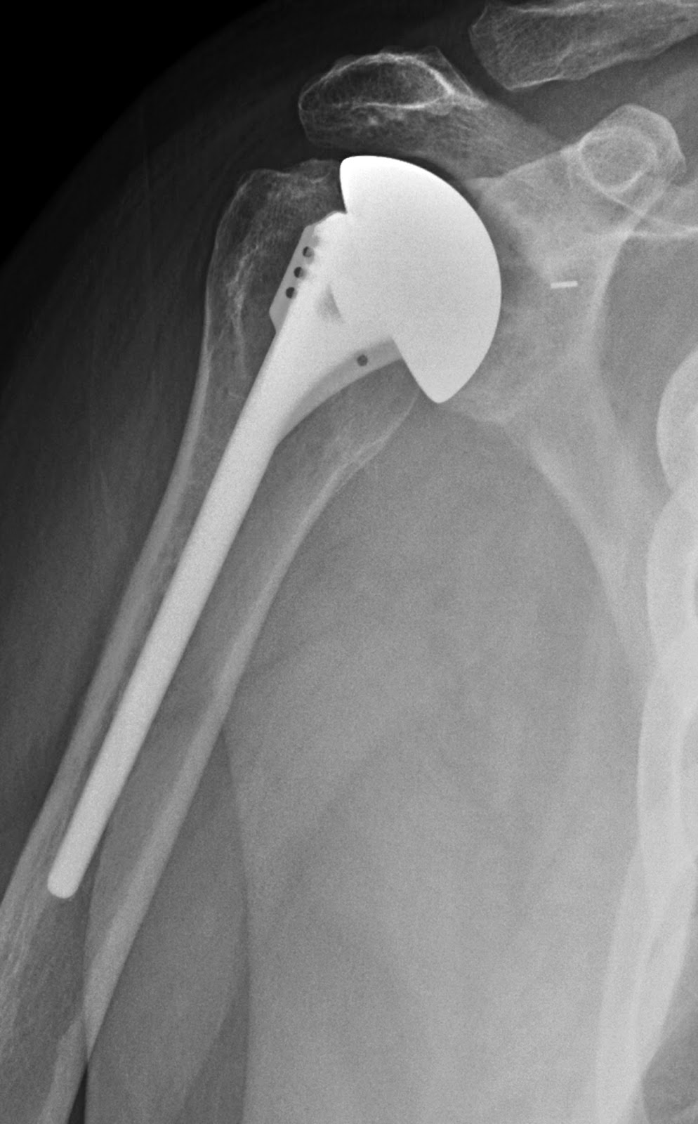 UW Shoulder and Elbow Academy: Stress shielding, component positioning ...