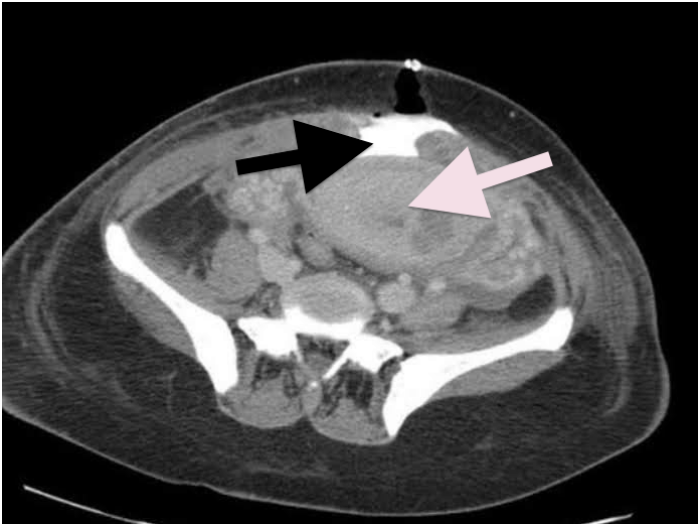 Journal Of Postgraduate Gynecology And Obstetrics Postpartum Urinary