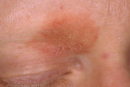 Scalp Sores Caused by Seborrheic Dermatitis - Treatment For Seborrheic ...