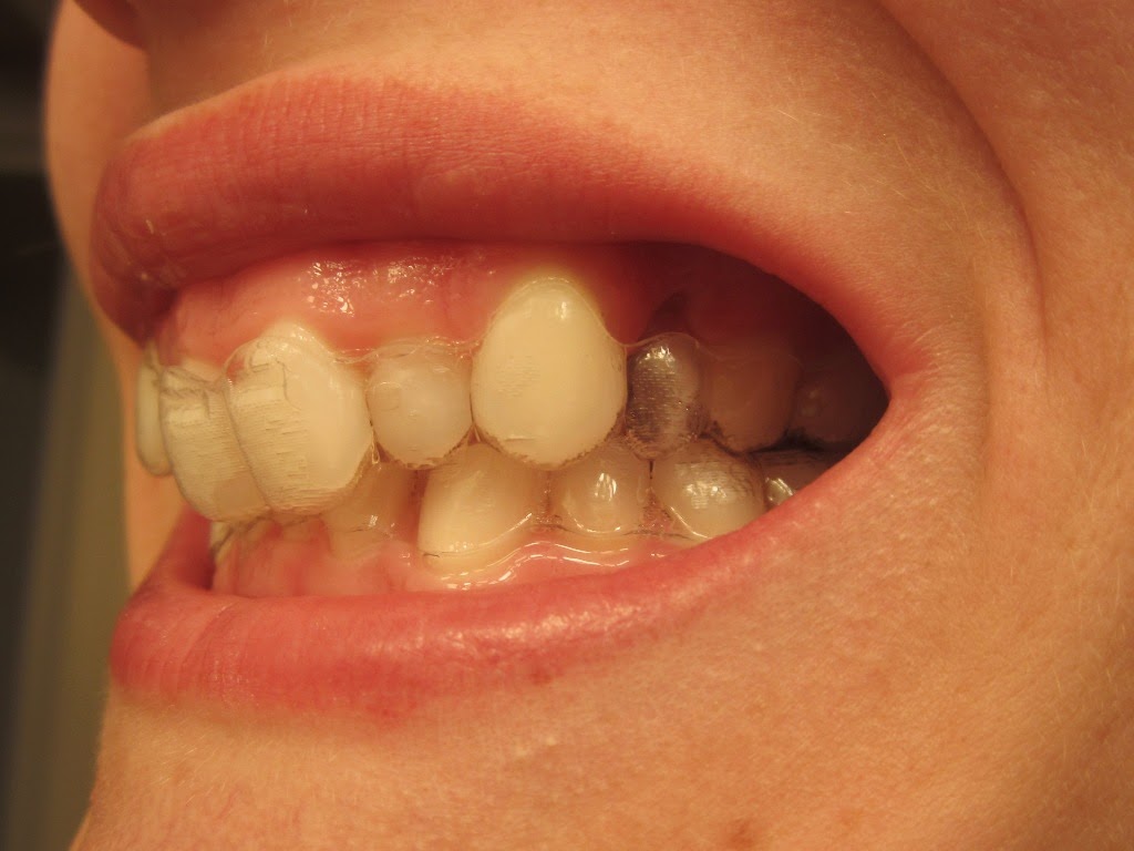 Creatively Titled Blog about Invisalign: Third Trays