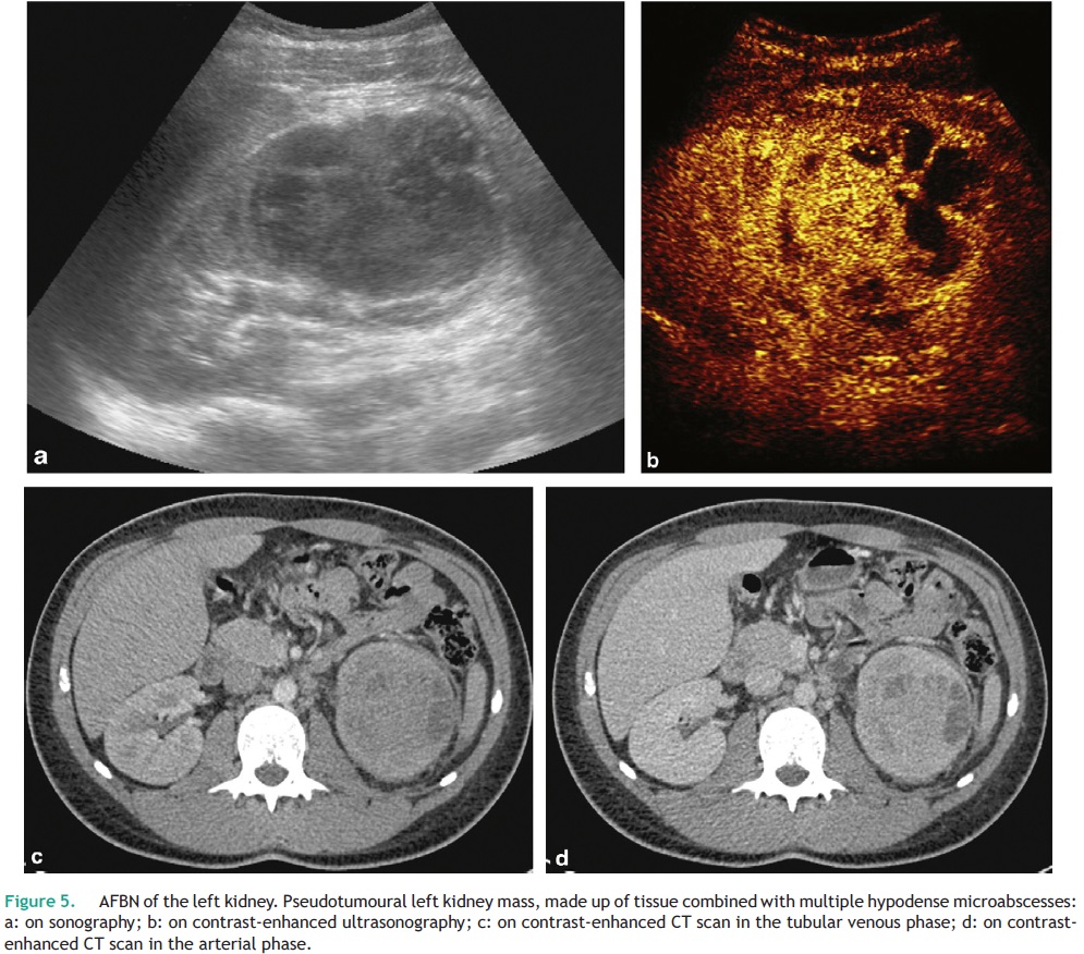 松下 ER ランチ・カンファレンス: AFBN 急性巣状細菌性腎炎