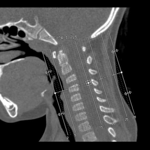 Children's Chiari Journal: More on Instability, Syrinxs/syringomyelia ...