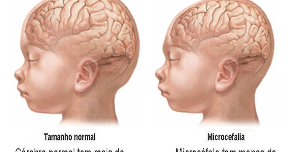 COMPROMISSO CONSCIENTE: MICROCEFALIA PODE SER CAUSADA PELO AGROTÓXICO 2 ...