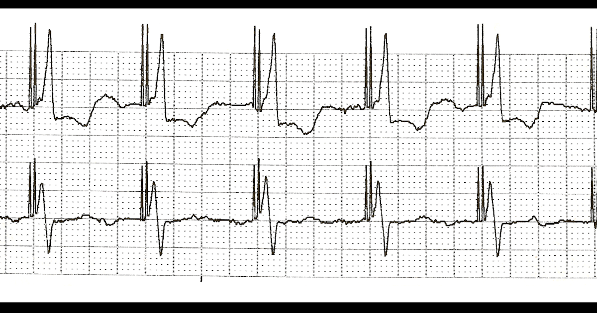 Float Nurse: Practice EKG Strips 345