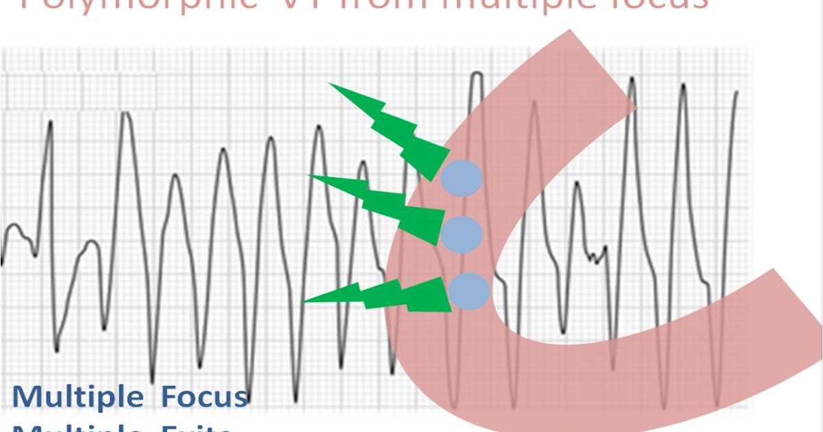 Polymorphic Ventricular Tachycardia | INA - ECG