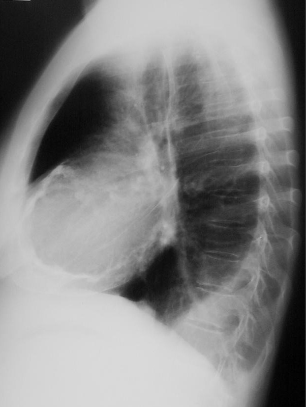VIDA Y PERICARDITIS CONSTRICTIVA: Mi periplo hasta el diagnóstico.