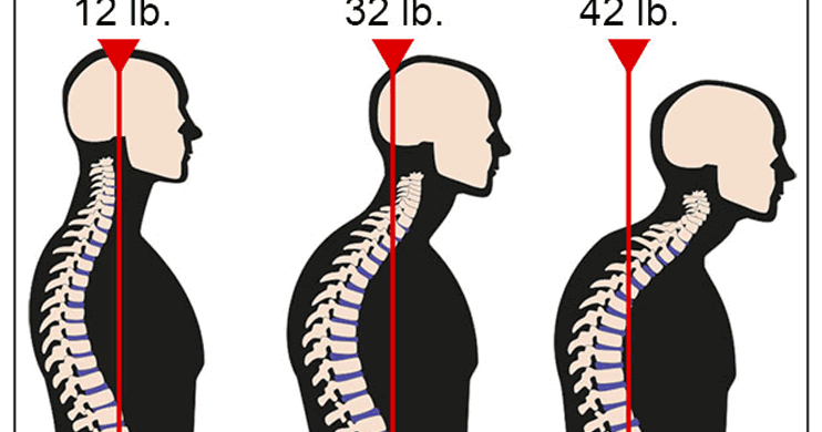 Family First Chiropractic and Wellness: Forward Heads Increase Head Weight