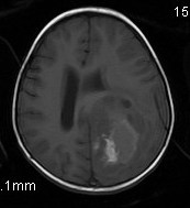 Atypical teratoid/rhabdoid tumors-MR - Sumer's Radiology Blog