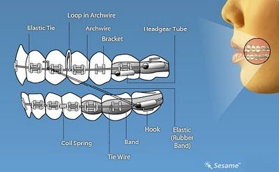 Sanborn Orthodontics: Braces 101 with Sanborn Orthodontics