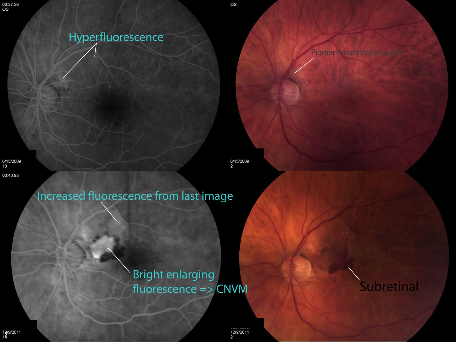 FUNdus exams: Wet AMD with new subretinal hemorrhage