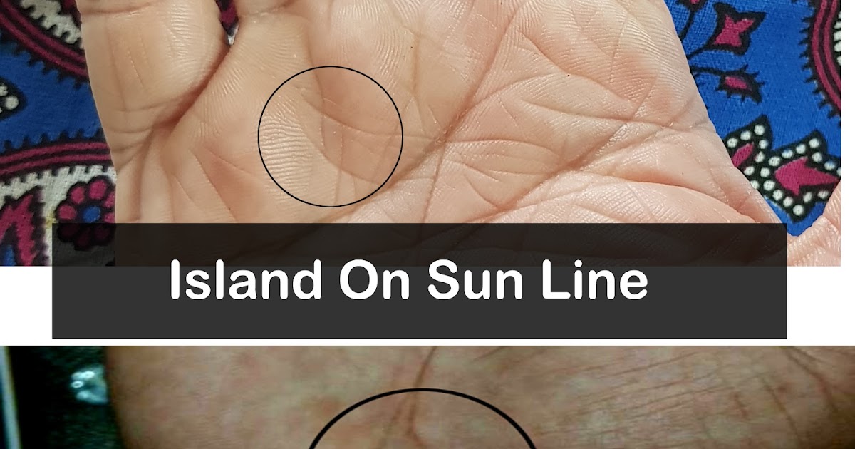 How To Differentiate Between Island on Sun Line And Fish Sign On Sun ...