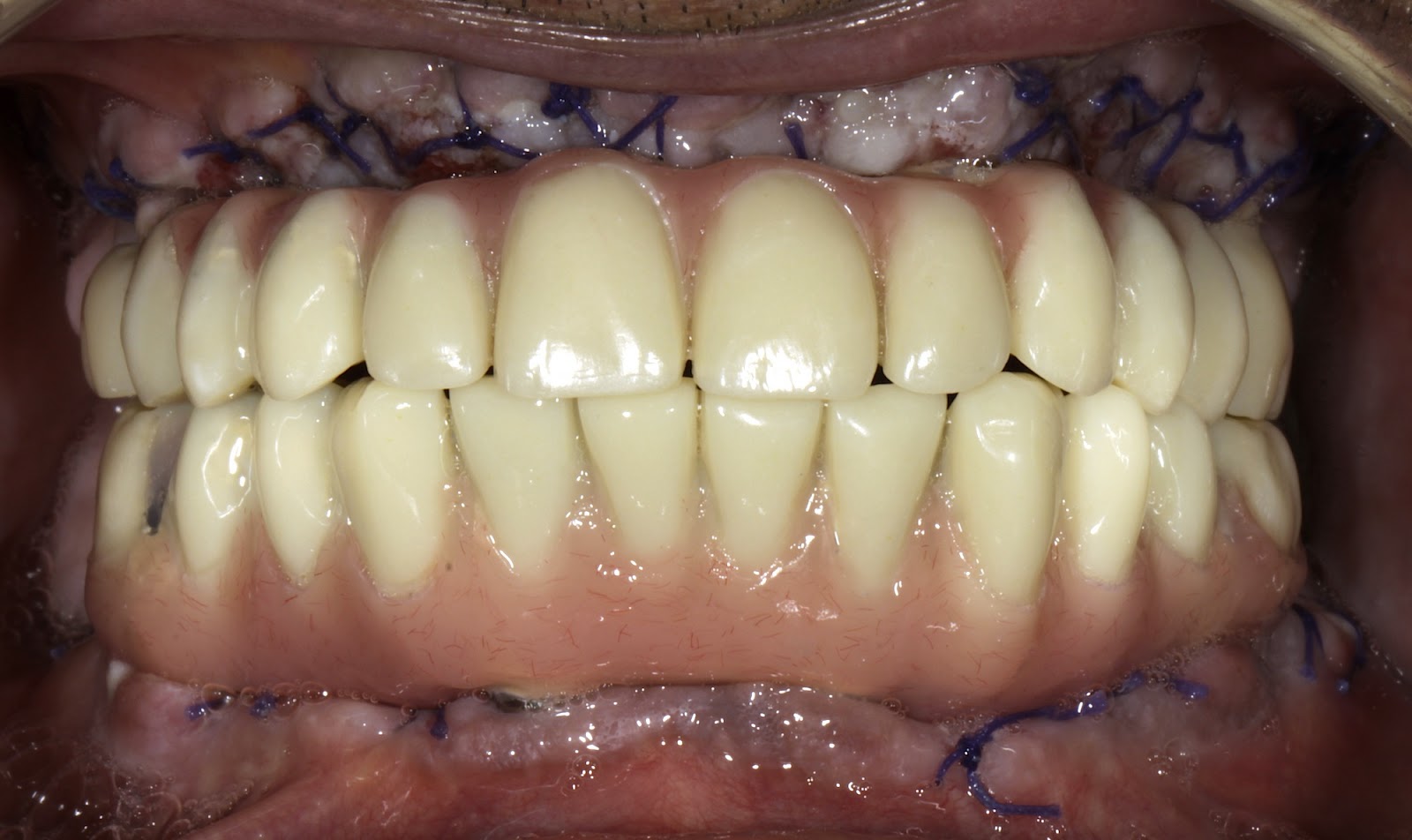 Terapia rehabilitadora con prótesis inmediata - Odontología Virtual