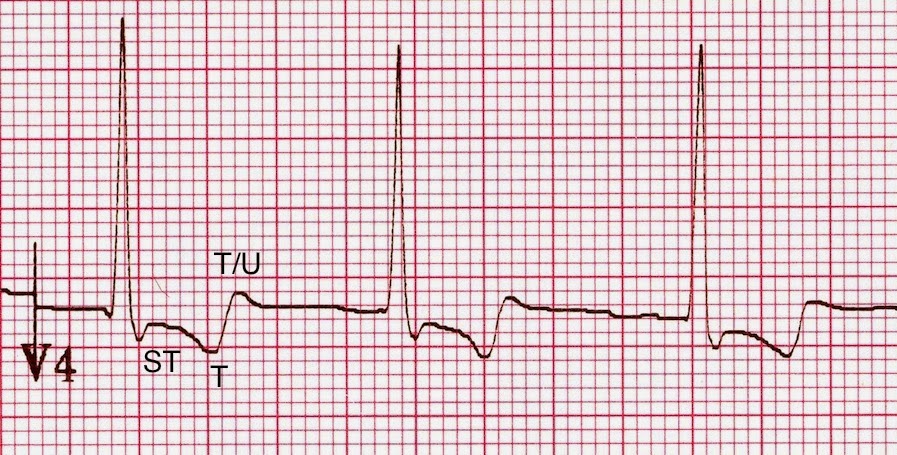 Enciclopédia de ECG - Diagnóstico