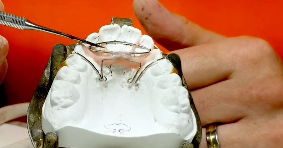 ORTHODONTIC: Super Spring Retainer w/ Helical Loops (Long Version ...