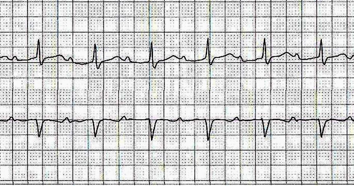 ECG Channel: Atrioventricular Block