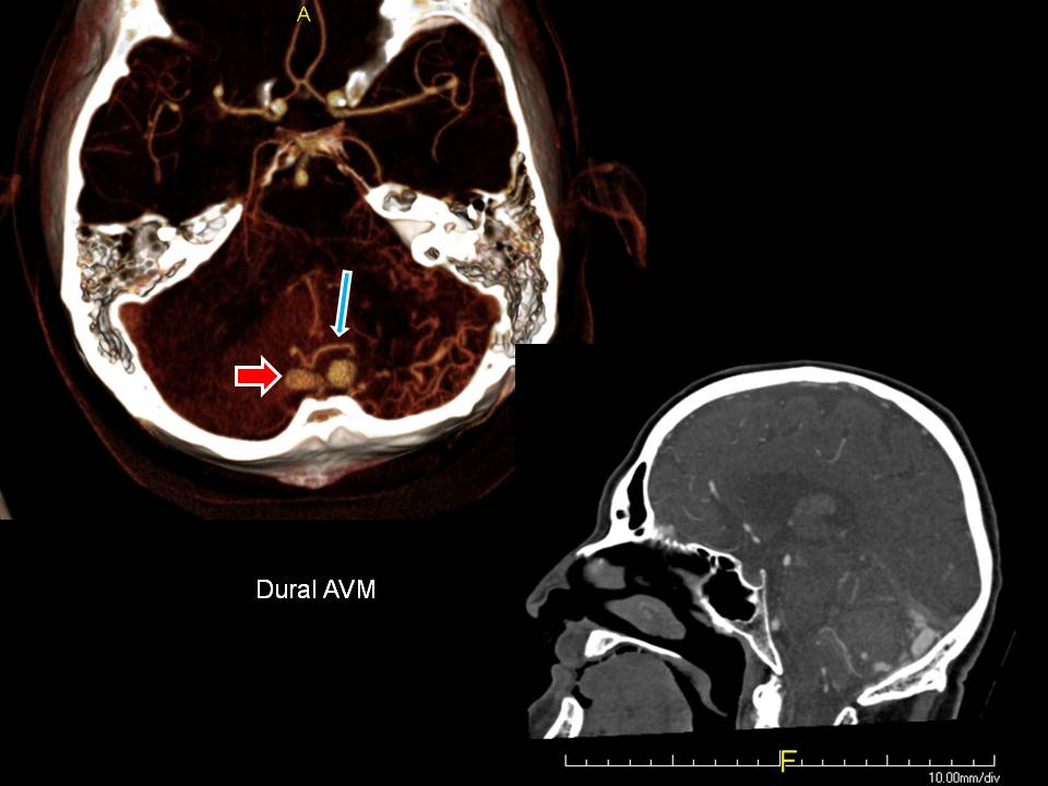 University of Toledo Radiology: Dural AVM