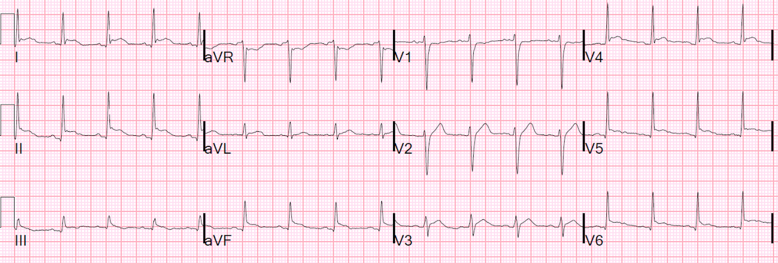 Dr. Smith's ECG Blog: Diffuse ST Elevation. Diagnosis confirmed with ...