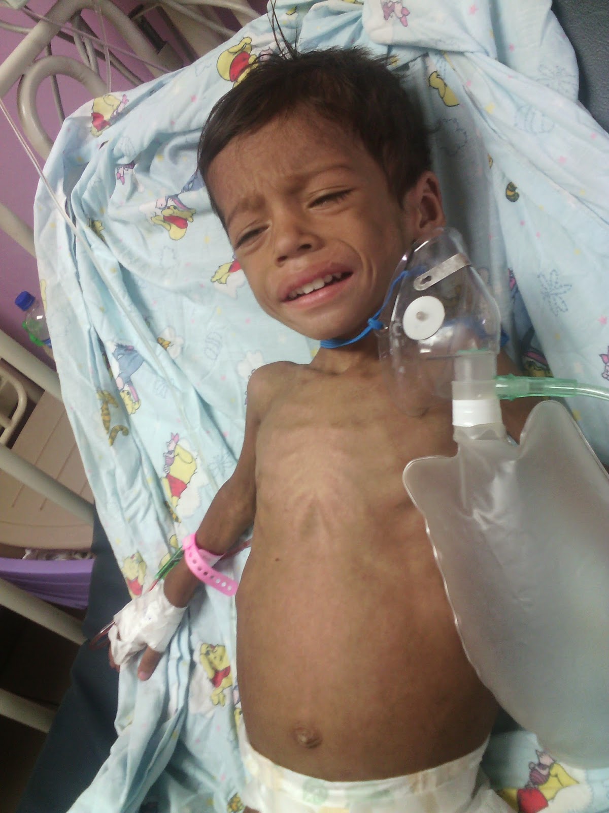 mi blog sobre crecimiento y desarollo: MARASMO