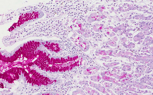 Pas Stain (Periodic acid–Schiff stain) | eMedicalHelp