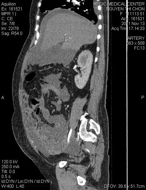 BÀI SOẠN VỀ SIÊU ÂM CHẨN ĐOÁN: 2 CASES of EXTRAOVARIAN PRIMARY ...