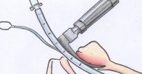 Tindakan Intubasi / Pemasangan ETT (Endo Tracheal Tube)