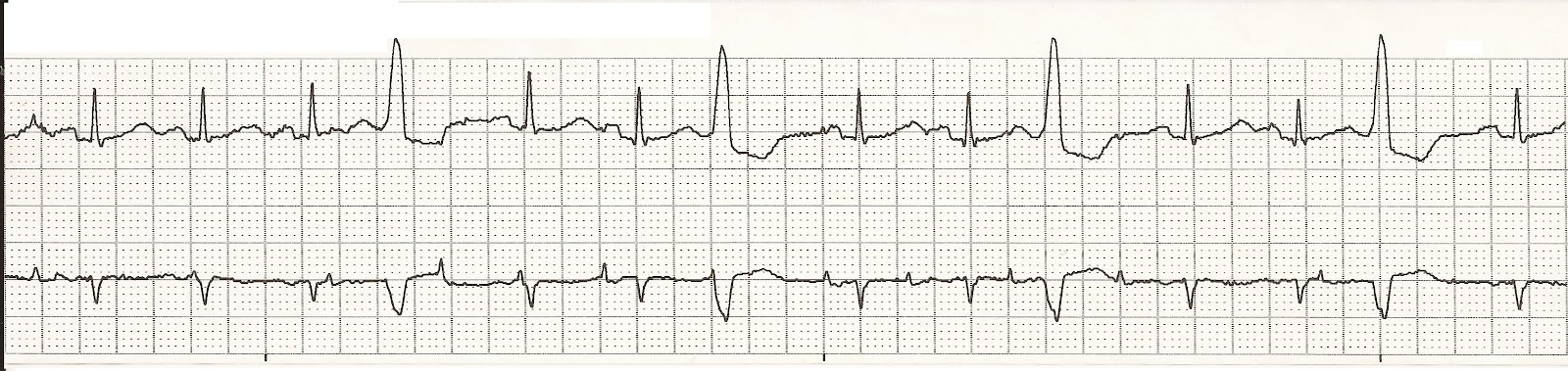 EKG Rhythm Strip Quiz 43