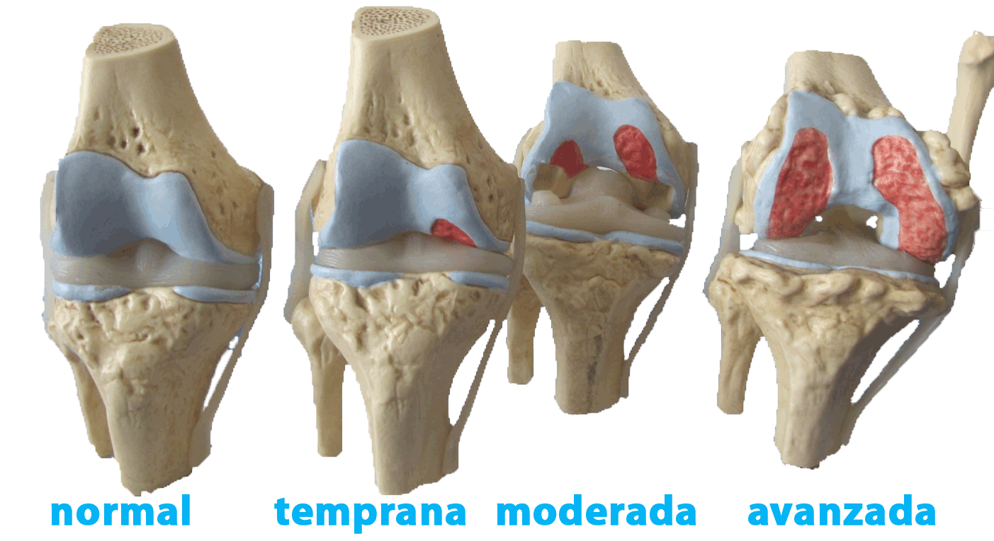 La Artrosis : Síntomas y Prevención. - MENTE & CUERPO SANO