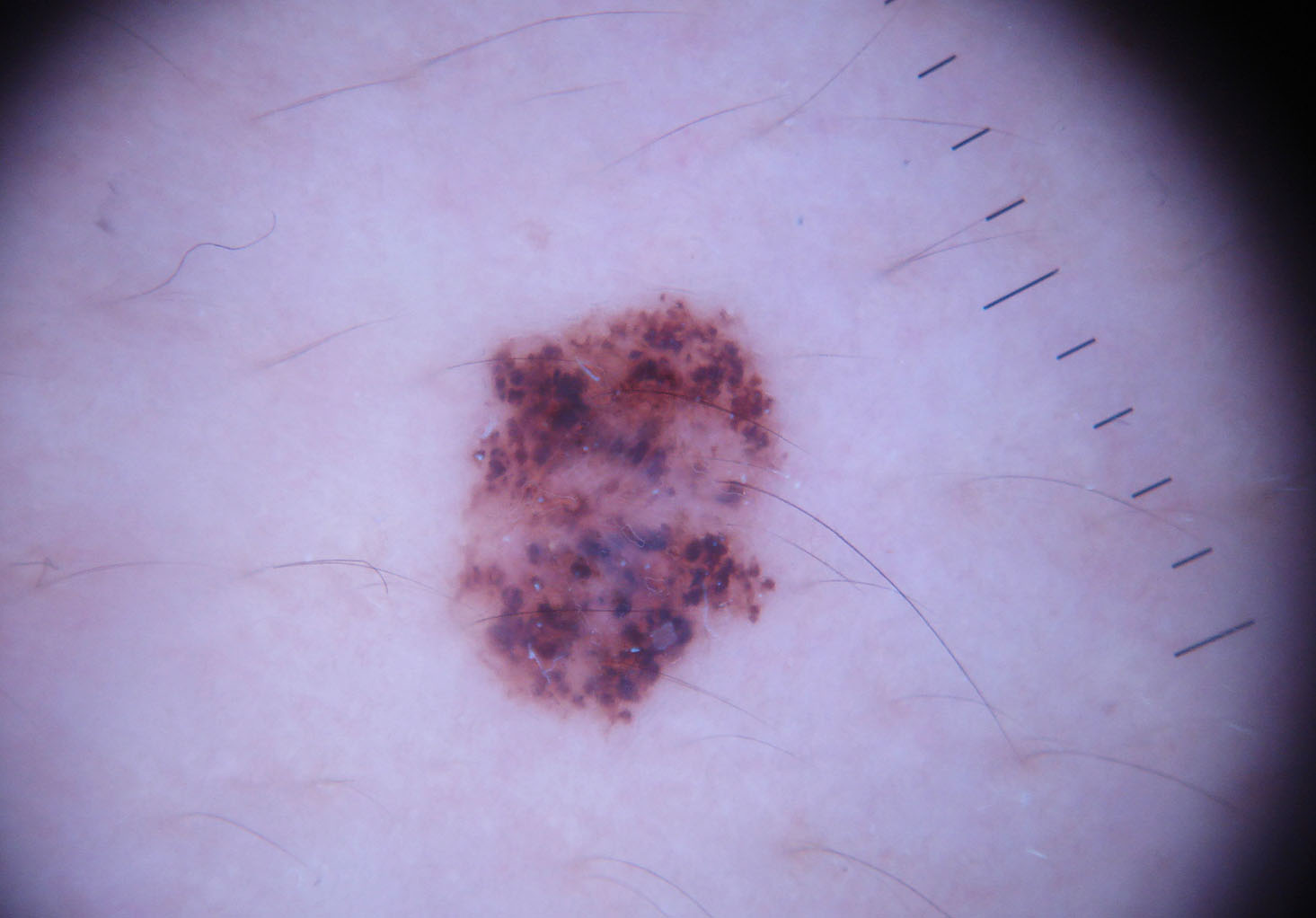 VIRTUAL GRAND ROUNDS IN DERMATOLOGY 2.0: Active Nevus